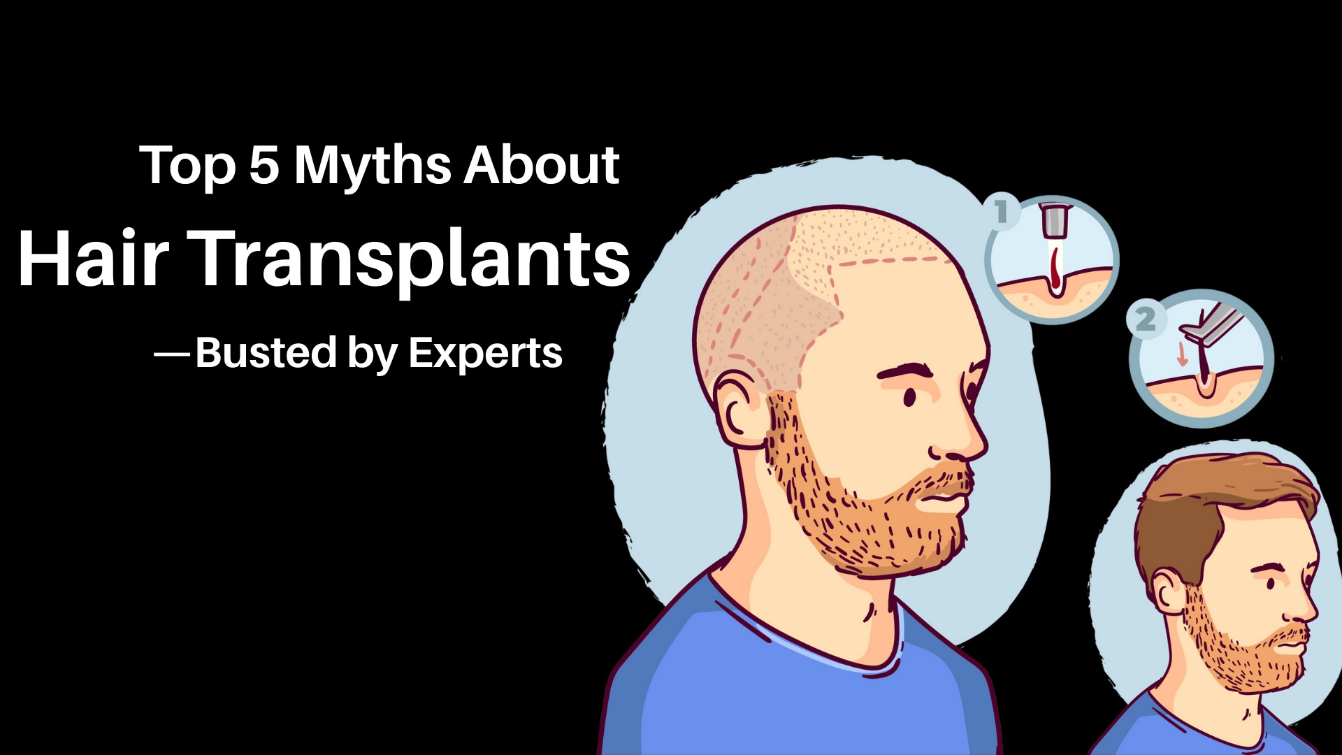 Top 5 Myths About Hair Transplants—Busted by Experts – Evolved Hair India